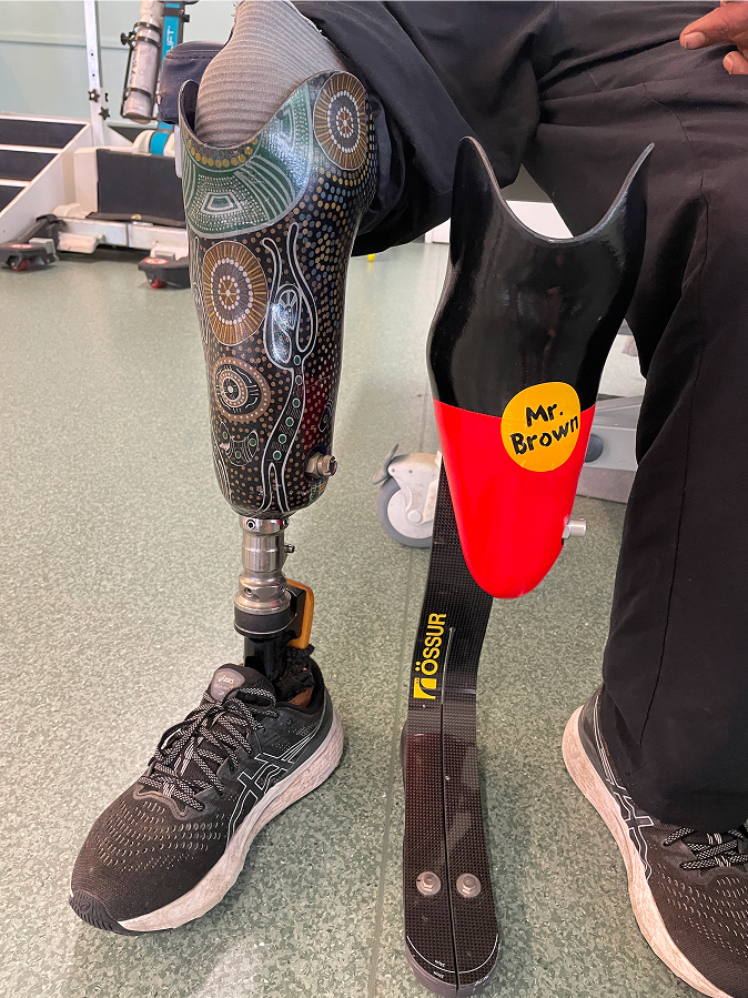 Types of Prosthetic Legs | ForMotion Clinics