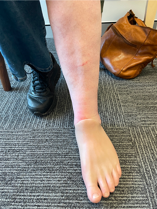 Types of Prosthetic Legs | ForMotion Clinics